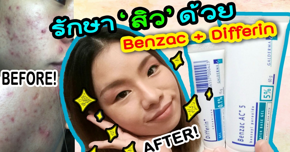 เป็นสิวทำไงดี!? หน้าใสไร้สิวด้วย Benzac & Differin ช่วยรักษาสิวอุดตัน ...