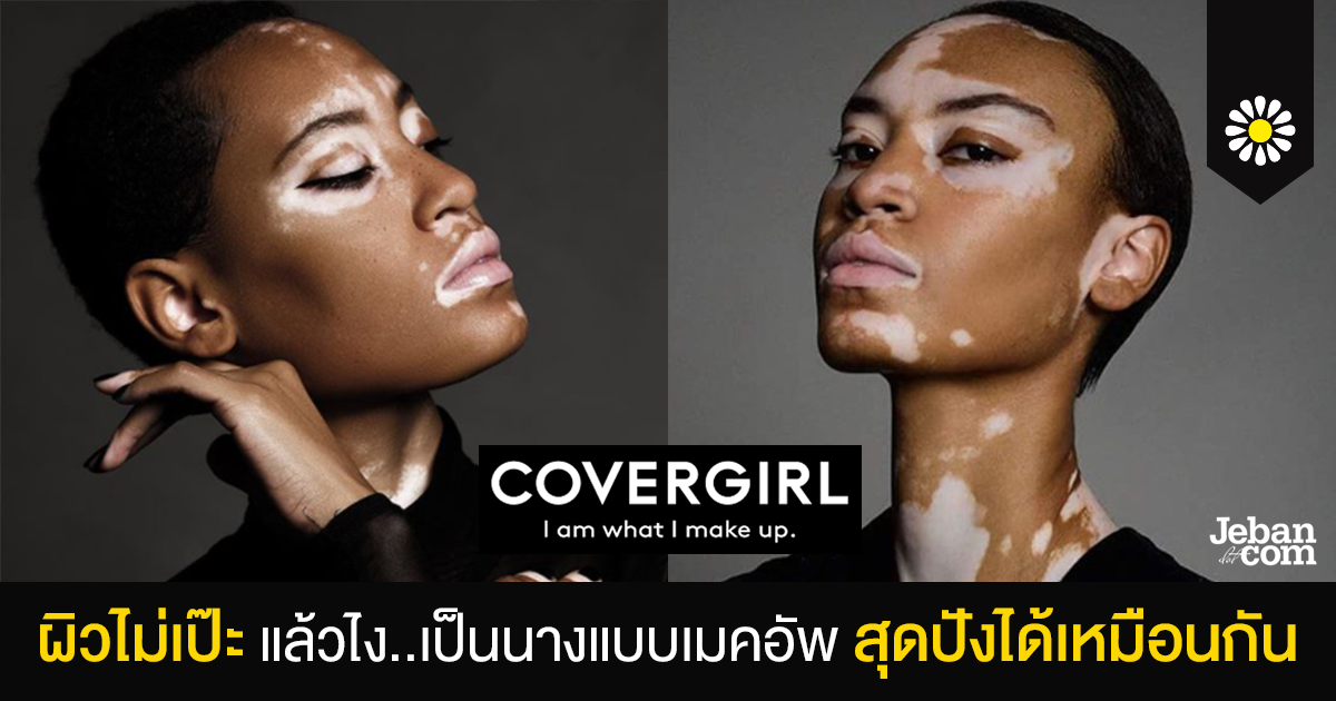 Amy Deanna สาวผิวสี กับโรคด่างขาว..ผิวไม่เป๊ะแล้วไง เป็นนางแบบสุดปังได้ ...