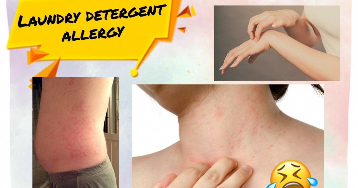 Laundry detergent allergy แก้ได้ที่ตัวเรา I Call me BT