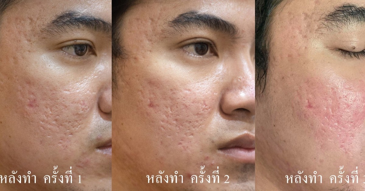 MCL 31 เลเซอร์รักษาหลุมสิว ครั้งที่ 3 !! จัดต่อหน้าเนียนขึ้นเยอะ