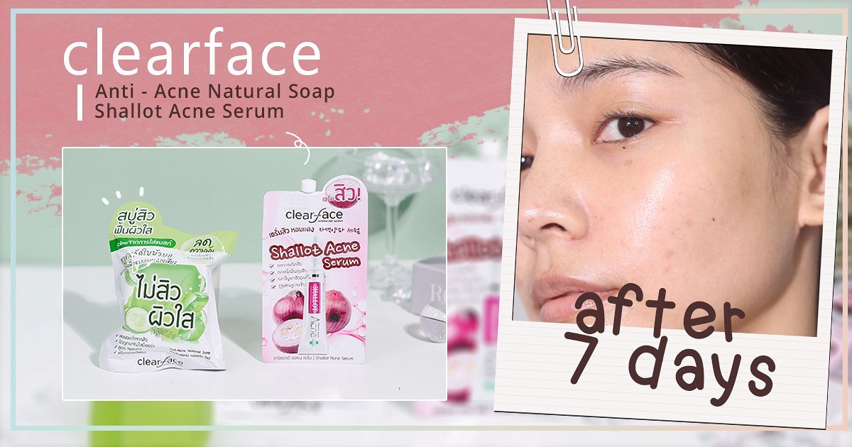 จัดการสิว รอยสิวใน 7 วัน หลักสิบผิวก็ดีขึ้นได้นะ | clearface