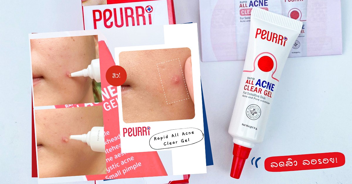 สยบทุกปัญหาสิวด้วย Peurri Rapid All Acne Clear Gel [ หลอดเดียวเอาอยู่ ]