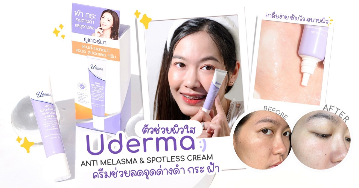 ยกใจให้ Uderma Anti Melasma บอกลา กระ ฝ้า หน้าหมอง 🧏🏻‍♀️👋🏻