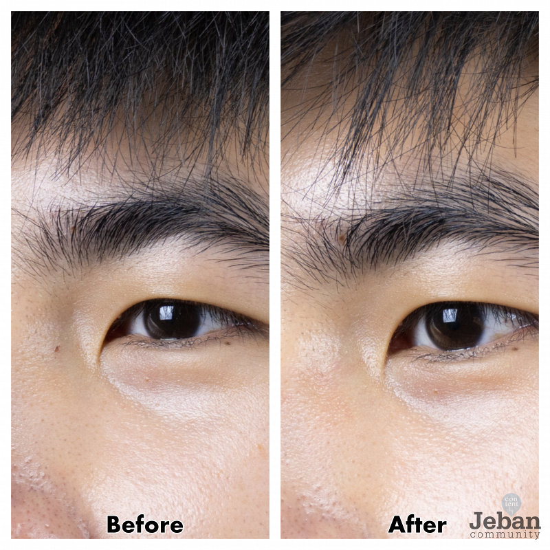 เคลียร์จบทุกรอยแผลเป็นง่ายๆ ราวกับไม่มีเคยมีมาก่อนด้วย Kelosil Silicone ...