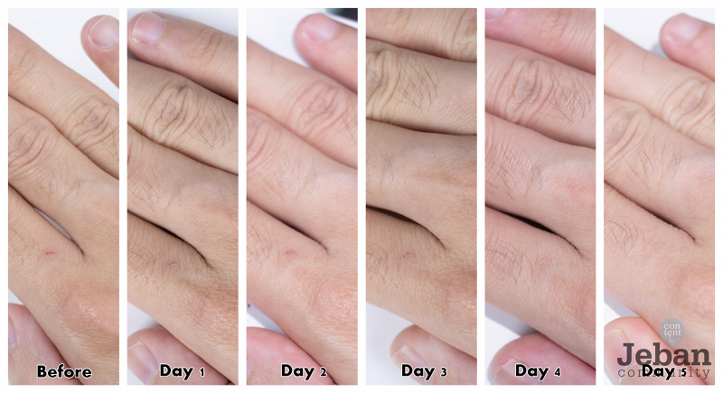 เคลียร์จบทุกรอยแผลเป็นง่ายๆ ราวกับไม่มีเคยมีมาก่อนด้วย Kelosil Silicone ...