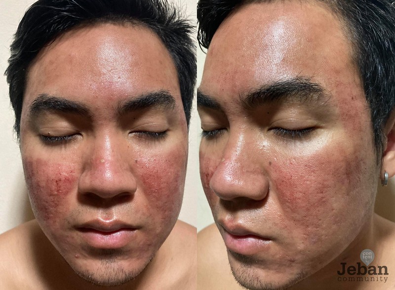 MCL 31 เลเซอร์รักษาหลุมสิว ครั้งที่ 3 !! จัดต่อหน้าเนียนขึ้นเยอะ