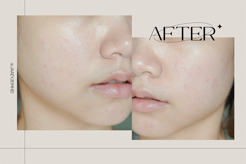 รีวิว FYNE BHA Clarifying Serum หลังใช้มา 1 เดือน จะเป็นยังไง?!