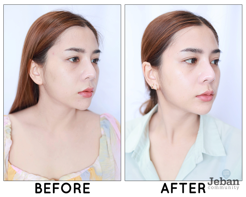 ผิวใสไกลสิวด้วยงบไม่เกิน 200 | by Clearface