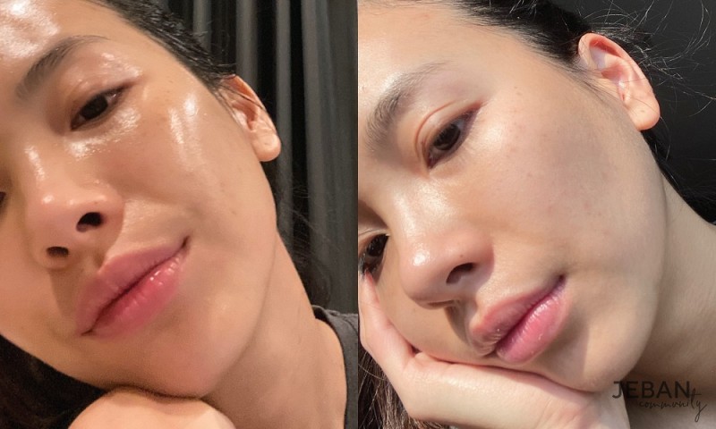 Glass Skin Vs Oily Skin ผิวกระจกต่างจากผิวมันเยิ้มยังไง เป็นสิวมีผิว