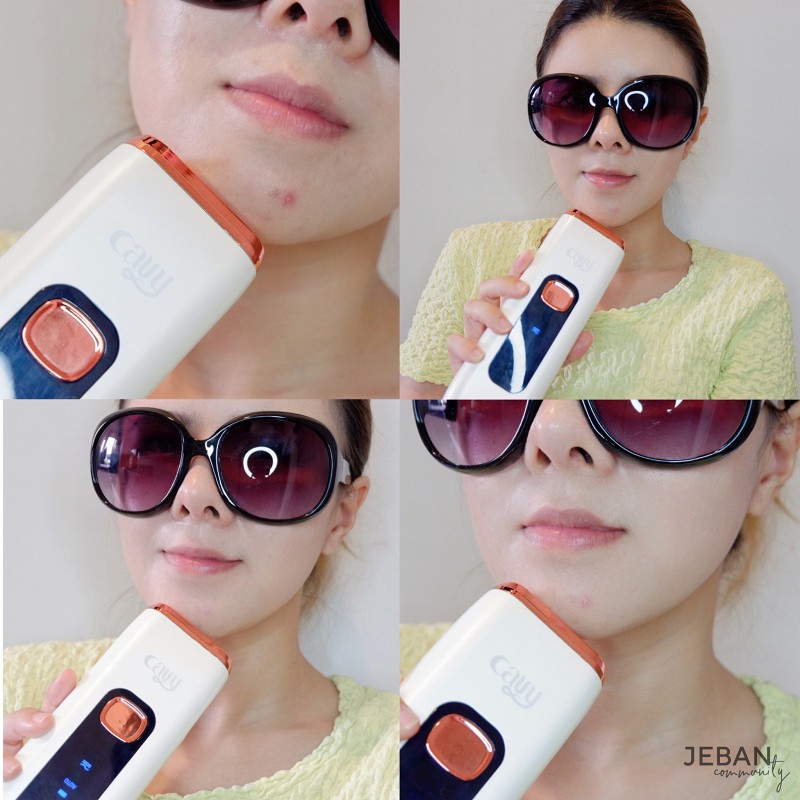 รีวิว Cavy mini IPL เหมือนพกคลีนิคติดตัว