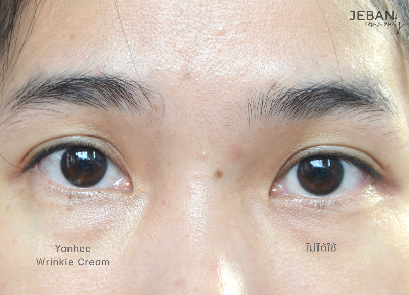 ลดริ้วรอยร่องลึกบนใบหน้า เพื่อผิวเรียบตึงทั้งบริเวณหน้าผาก หางตา และ ร่องแก้ม ด้วย Yanhee ...